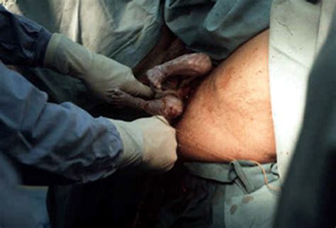 Breech Extraction Meddic