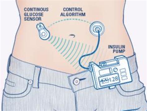 Figure 1 From Fuzzy Model Predictive Controller For Artificial Pancreas Semantic Scholar