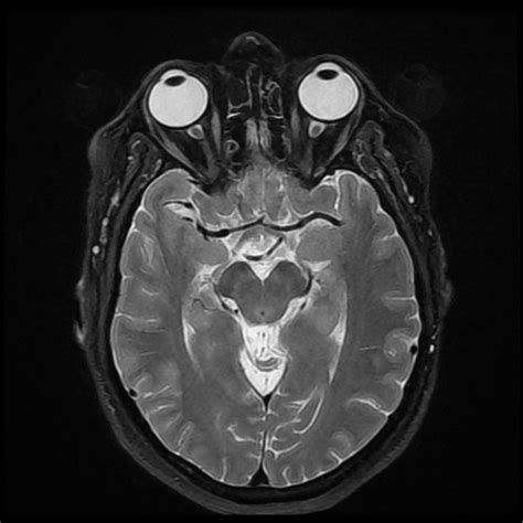 Radiopaedia Case Orbital Pseudotumor Id 39779 Study 42202 Nc Commons