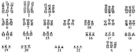 Filehuman Triploid Karyotype Wikimedia Commons