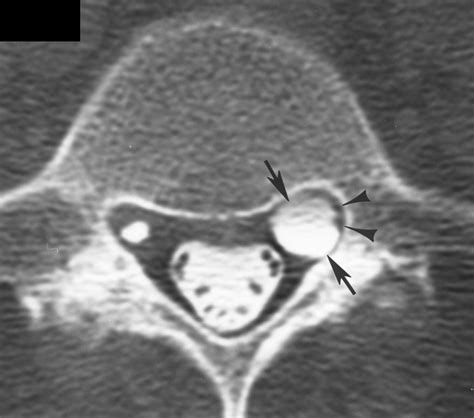 Ct Myelography And Mr Imaging Of Extramedullary Cysts Of The Spinal