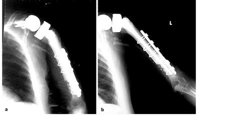 Postoperative View Showing The Proximal Humerus Revision Apc Long Stem Download Scientific