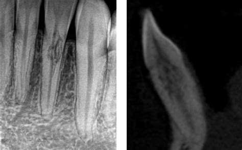 Conservative Endodontic Treatment For Cervical Invasive Resorption · Root Canal Specialty Associates