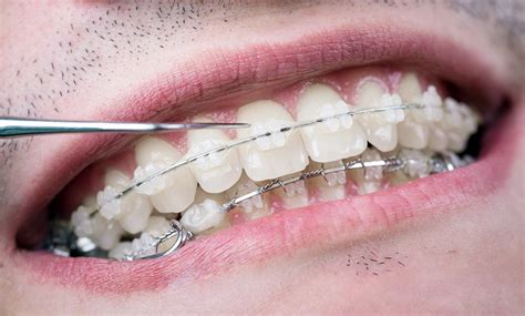 Clear Ceramic Braces Baker Street Dental