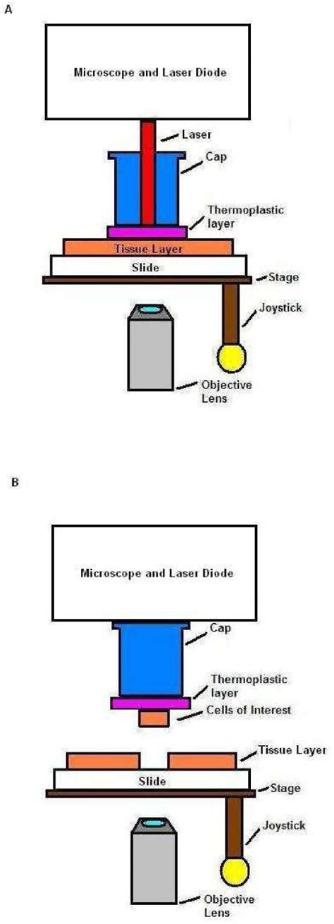 Figure 1 From Defining Disease With Laser Precision Laser Capture