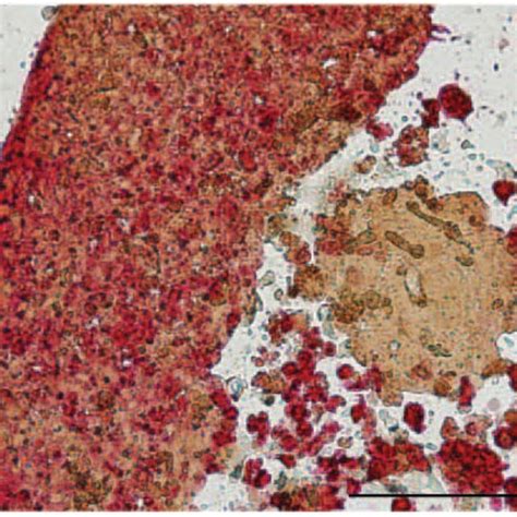Double Ihc Staining Image Light Microscope 100x Mag B16 F10 Brown