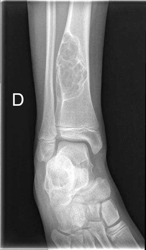 Tibia Derecha