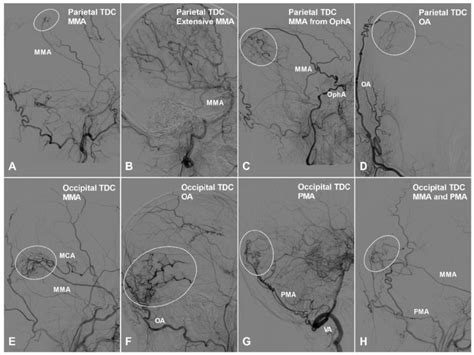 The Parietal And Occipital Tdcs A Angiogram Of The Eca In Lateral