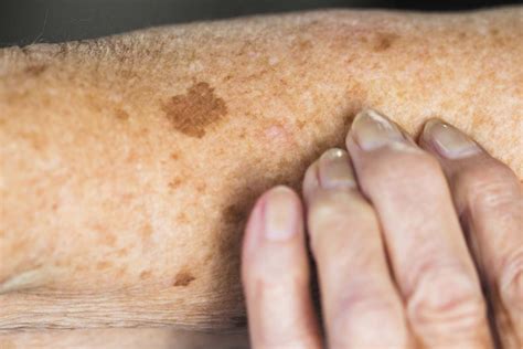 Whats The Difference Between Age Spots And Sun Spots Harvard Health