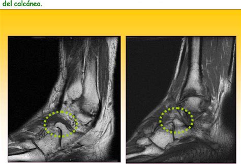 Figure 3 From Edema De Médula ósea Del Proceso Anterosuperior Del