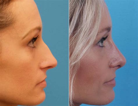 Turned Up Nose Profile