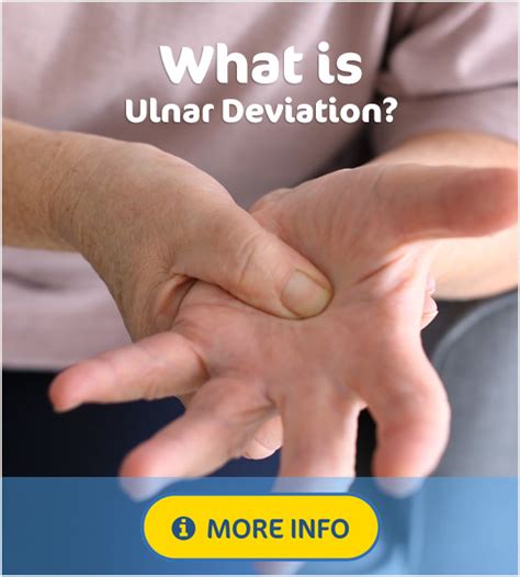 Wrist Supports For Ulnar Deviation Uk