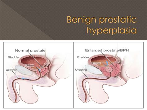 Solution Benign Prostatic Hypertrophy 2 Studypool