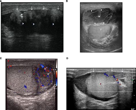 Frontiers Clinical And Ultrasound Features Of Fibrous Pseudotumor Of