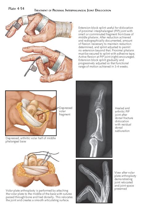 Dislocation Of Proximal Interphalangeal Joint Pediagenosis