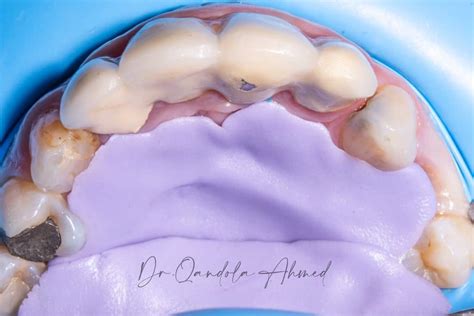 To Splint Or Not To Splint When Brain Gears Work More Than Neurotransmitters Myzerodonto