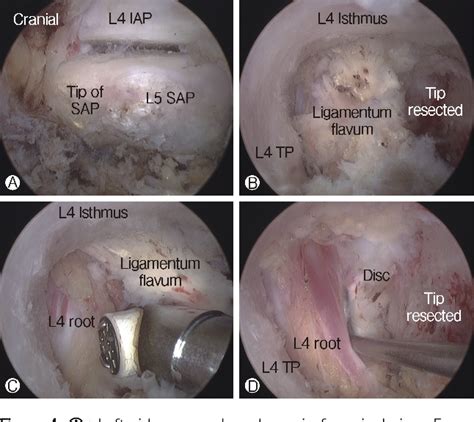 Figure 1 From Current Status Of Biportal Endoscopic Decompression For