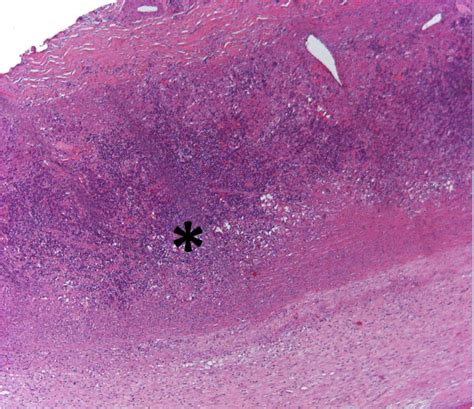 Aortic Wall Segment Of The Patient With Giant Cell Arteritis In This