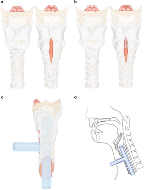 Apc Split Procedure A The Anterior Midline Incision B The Posterior Download Scientific