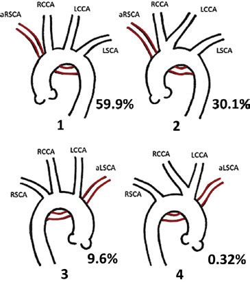 Aberrant Right Subclavian Artery R Medical