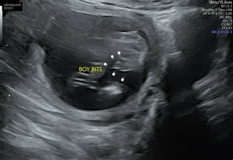 Gender Ultrasound Doesnt Look Right Mumsnet