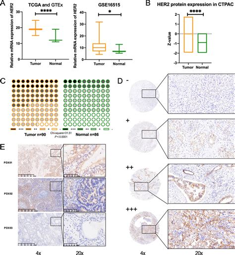 Up Regulation Of Her2 In Pdac A Bher2 Gene Expression And Protein