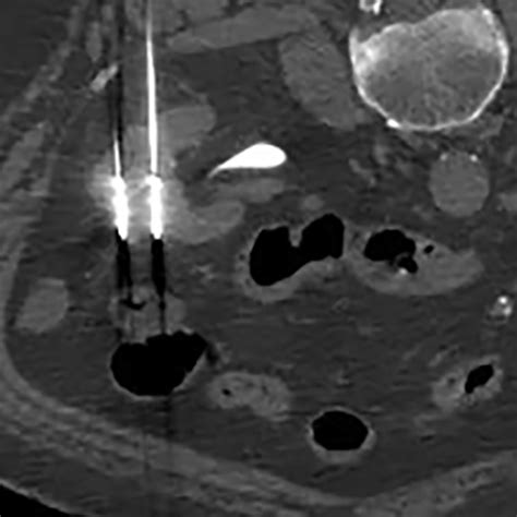 Patient 1 Pre Ablation Of Left Interpolar Renal 8x Lesion Axial
