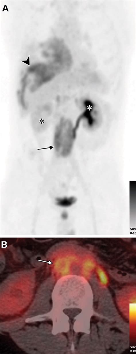 Large Vessel Vasculitis Multimodality Imaging Findings And Technical