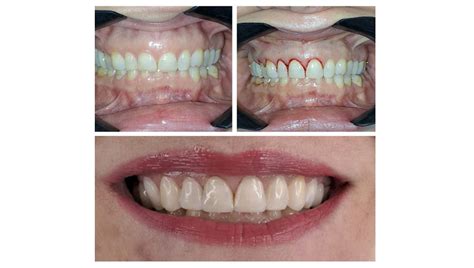 Gingivectomy And Gingivoplasty In Treatment Or Aesthetic Cases Telegrafi Telegrafi