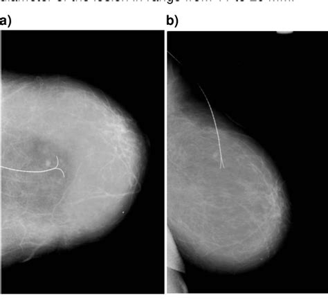 Wire Localization Breast At Bambi Foust Blog