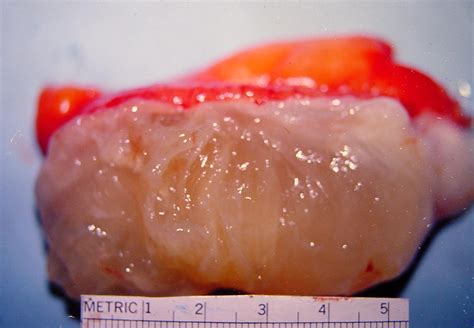 Appendix Neoplasm 1429 Mucocele Surgery Photos