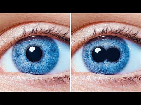 Multiple Pupils