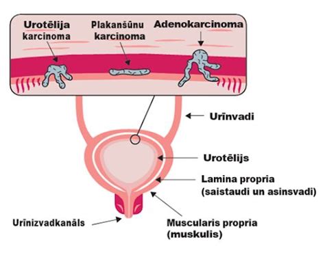 Slimība Roche Pacientes