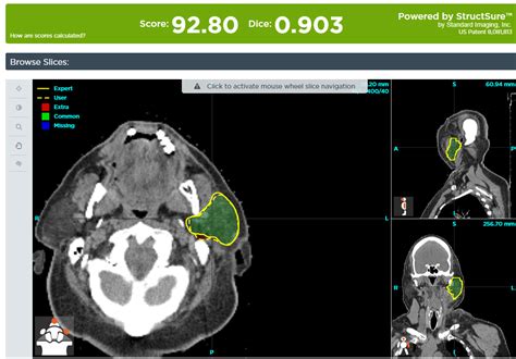Parotid Proknow Tyler Calhoun B S R T R T