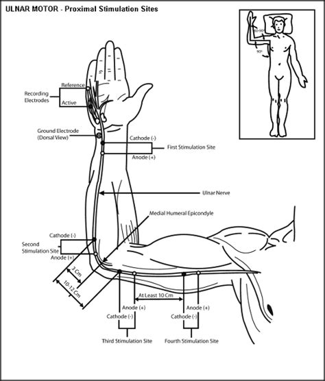 Role Of Electrodiagnosis In Ulnar Nerve Entrapments Physiopedia
