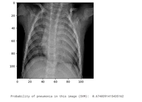 Ml Beginner S Guide To Build Pneumonia Detection Model