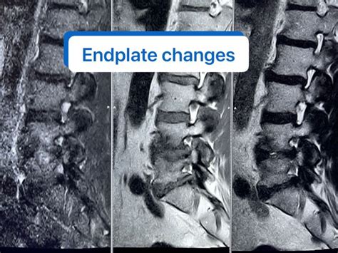 Glade Roper Md — Mskir On Linkedin Mskir Mri Intracept Transiliac