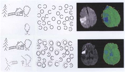 Clock Drawing Test And Unilateral Spatial Neglect At Troy Hager Blog