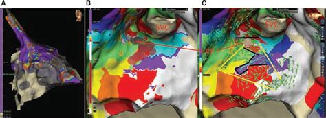 Figure 1 From Elucidation Of Complex Atrial Tachycardia Activation In A Patient With Tetralogy