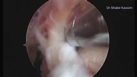 Dr Mohammed Kassim On Linkedin Arthroscopy Sportsinjuries Revisionacl Acl Knee