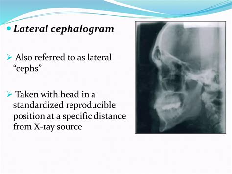 Cephalometrics Hard And Soft Tissue In Detail Pptx