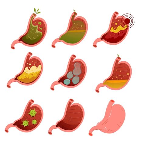 Estomac Avec Différents Types De Maladies Vecteur Premium