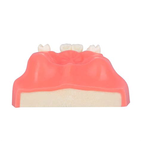 Maxillary Sinus Lift Surgery Practice Model Missing 9 Teeth