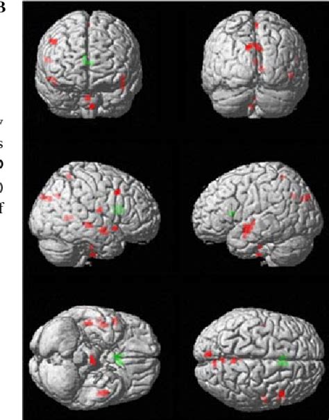 Adhd And The Role Of The Posterior Cingulate Cortex In Resting State