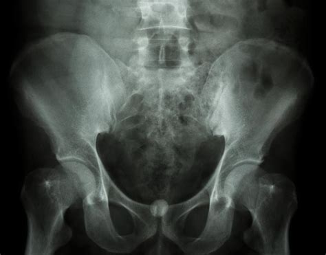 What Is A Cystogram With Pictures