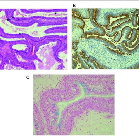 Photomicrograph Of Histopathological Finding Of Lesion Removed From The