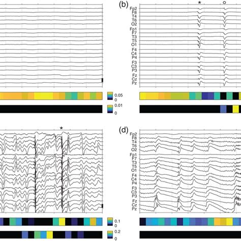 Visual Explanation For Eeg Epochs Correctly Classified By The Global