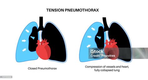 Tension Pneumothorax Poster Stock Illustration Download Image Now