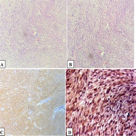 Histomicrographs Of Gist A B The Tumor Is Formed Of Spindle Cell