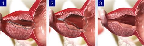 Itind Bph Enlarged Prostate Therapy